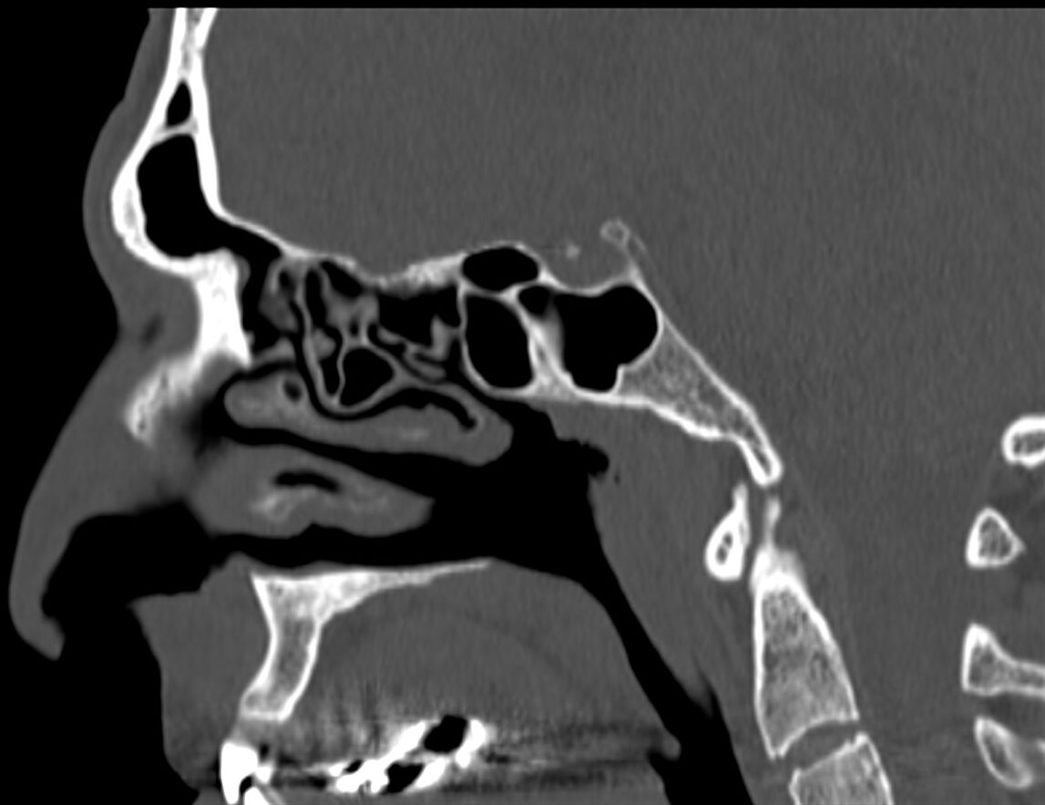 Massiccio facciale: varianti anatomiche