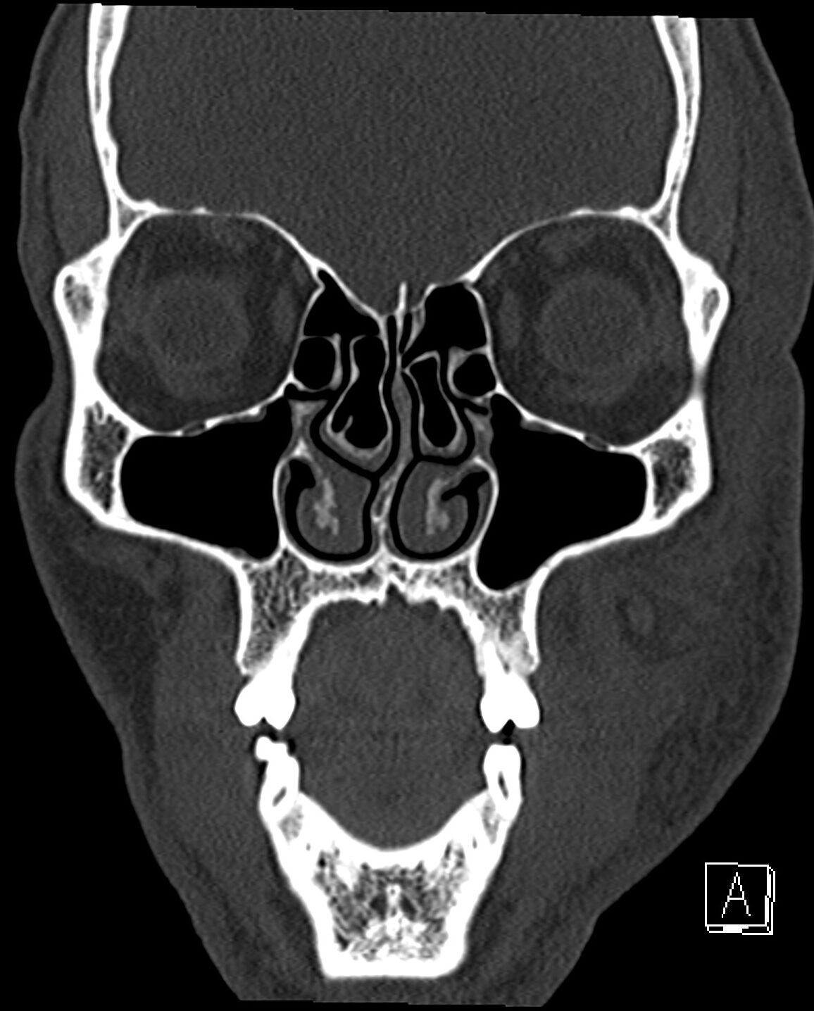Massiccio facciale: varianti anatomiche