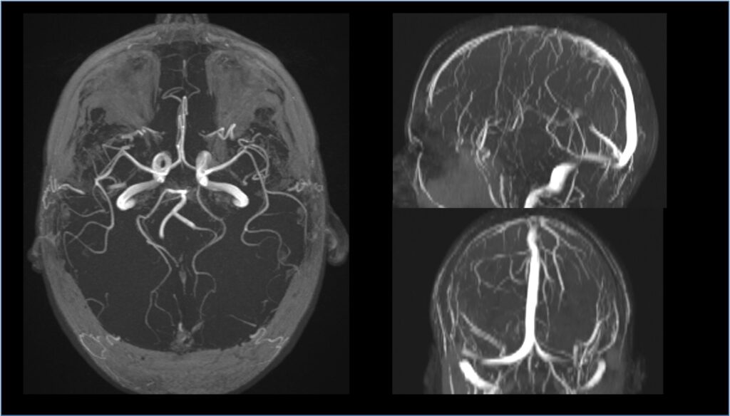 Angio-RM cerebrale