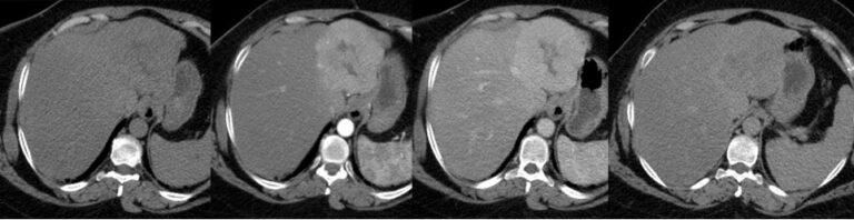 Lesioni epatiche benigne - TC ed RM